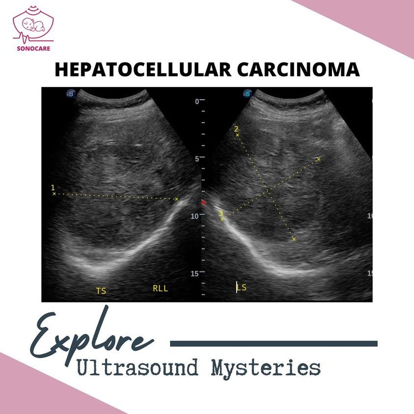Hepatocellular Carcinoma Ultrasound